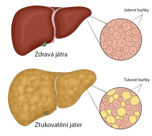 Steatóza jater | Superionherbs